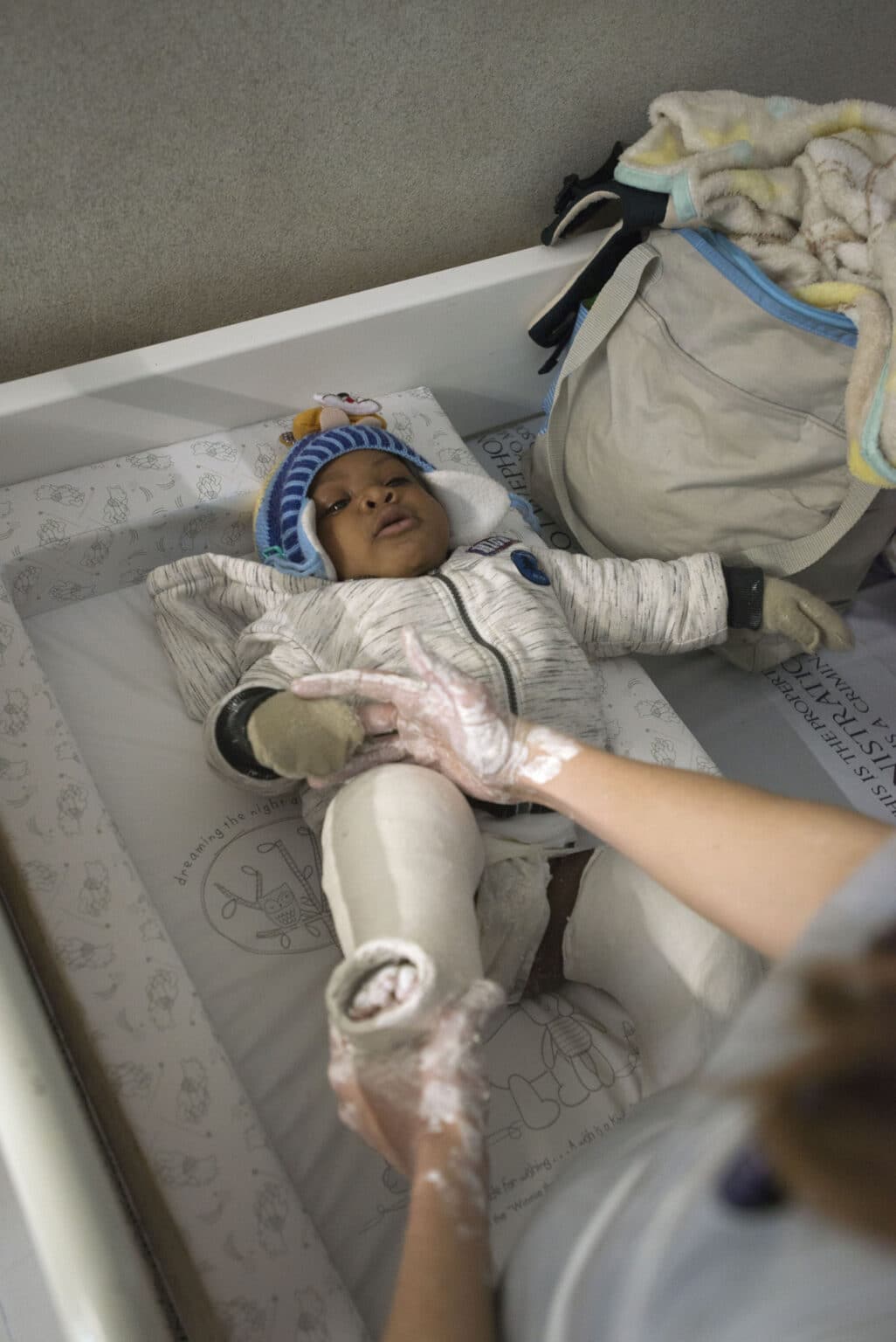 Clubfoot treatment - Steps | Clubfoot support in Southern Africa