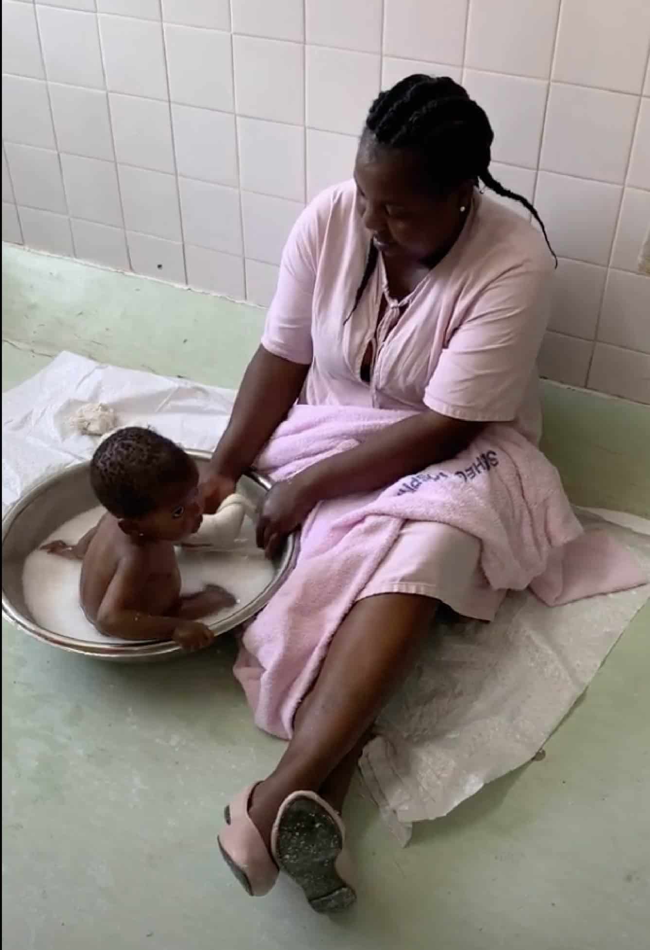 Clubfoot treatment - Steps | Clubfoot support in Southern Africa