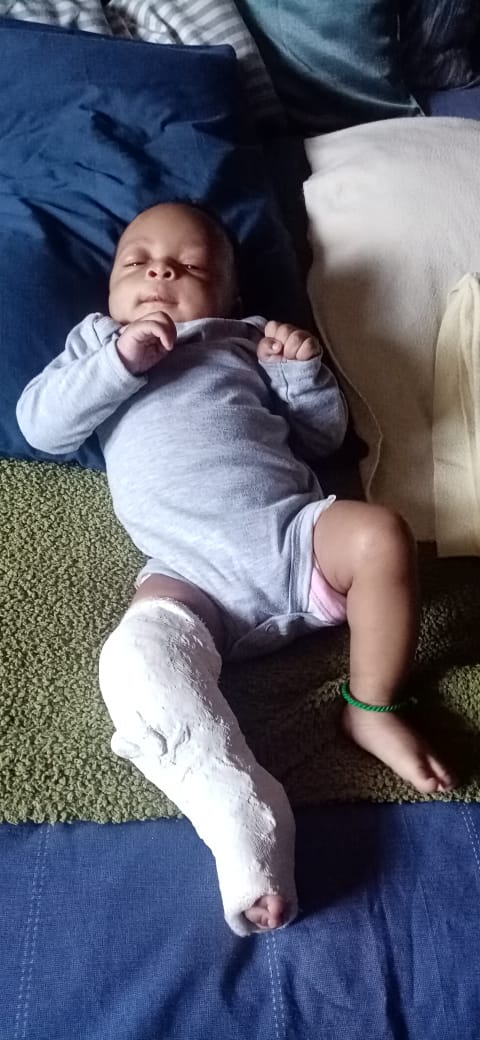 Meet Tisetso Rose: A Clubfoot Champion in the Making! - Steps ...